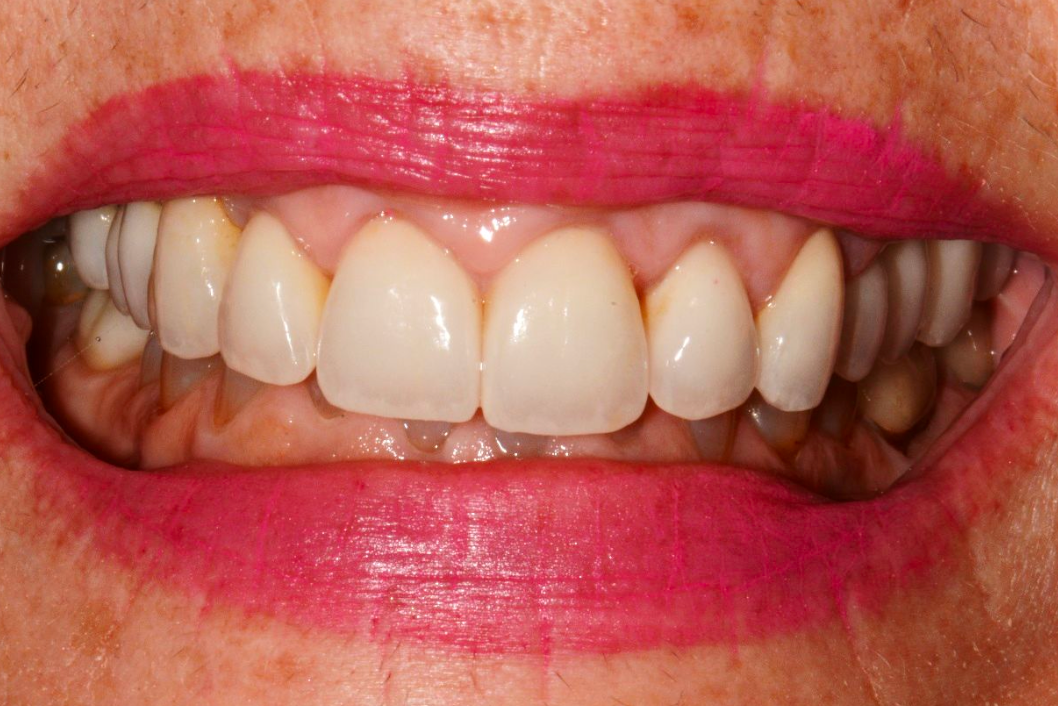 Before and After Gallery | Cosmetic Dentistry of Atlanta