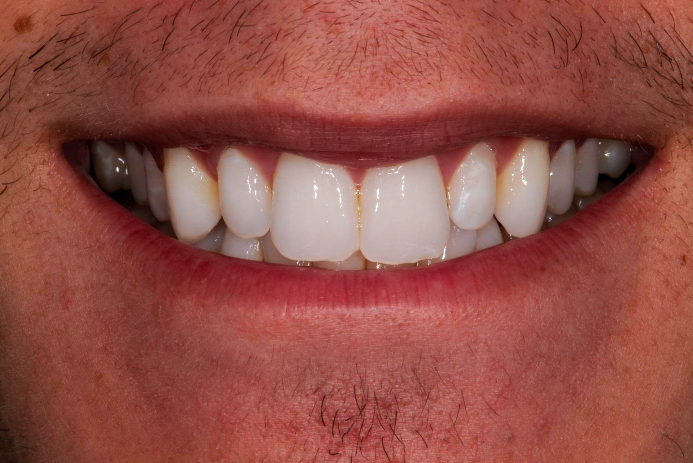 Before and After Gallery | Cosmetic Dentistry of Atlanta